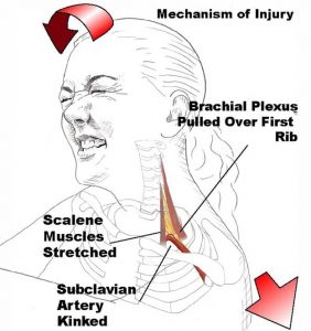 Why are your Hands Numb? - Neurological Associates The Interventional ...